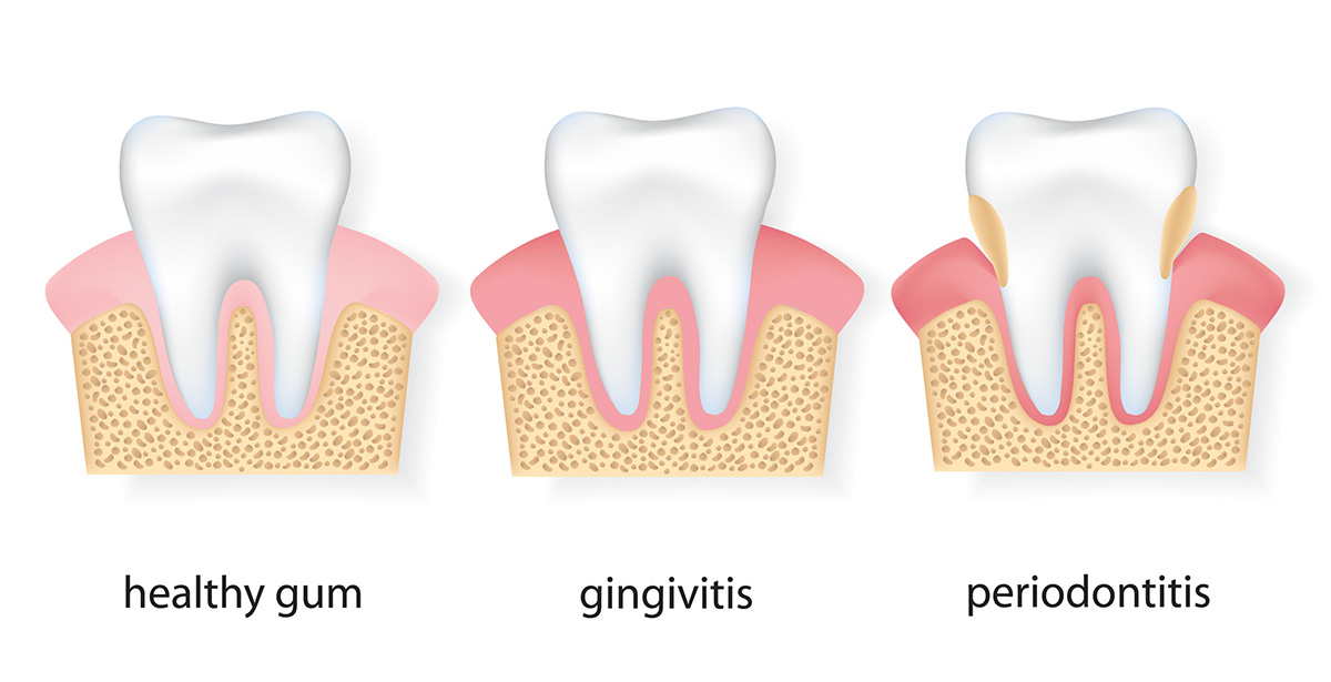 Periodontal Disease Treatment: Bone Grafts